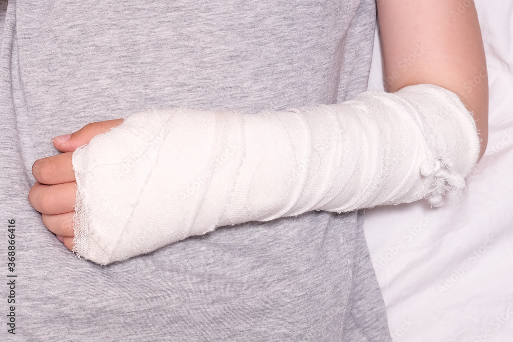 A child broken arm in plaster case, hand injury because of accident ...