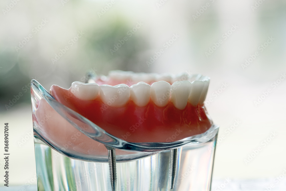 Teeth model showing an implant crown bridge model/ dental demonstration ...