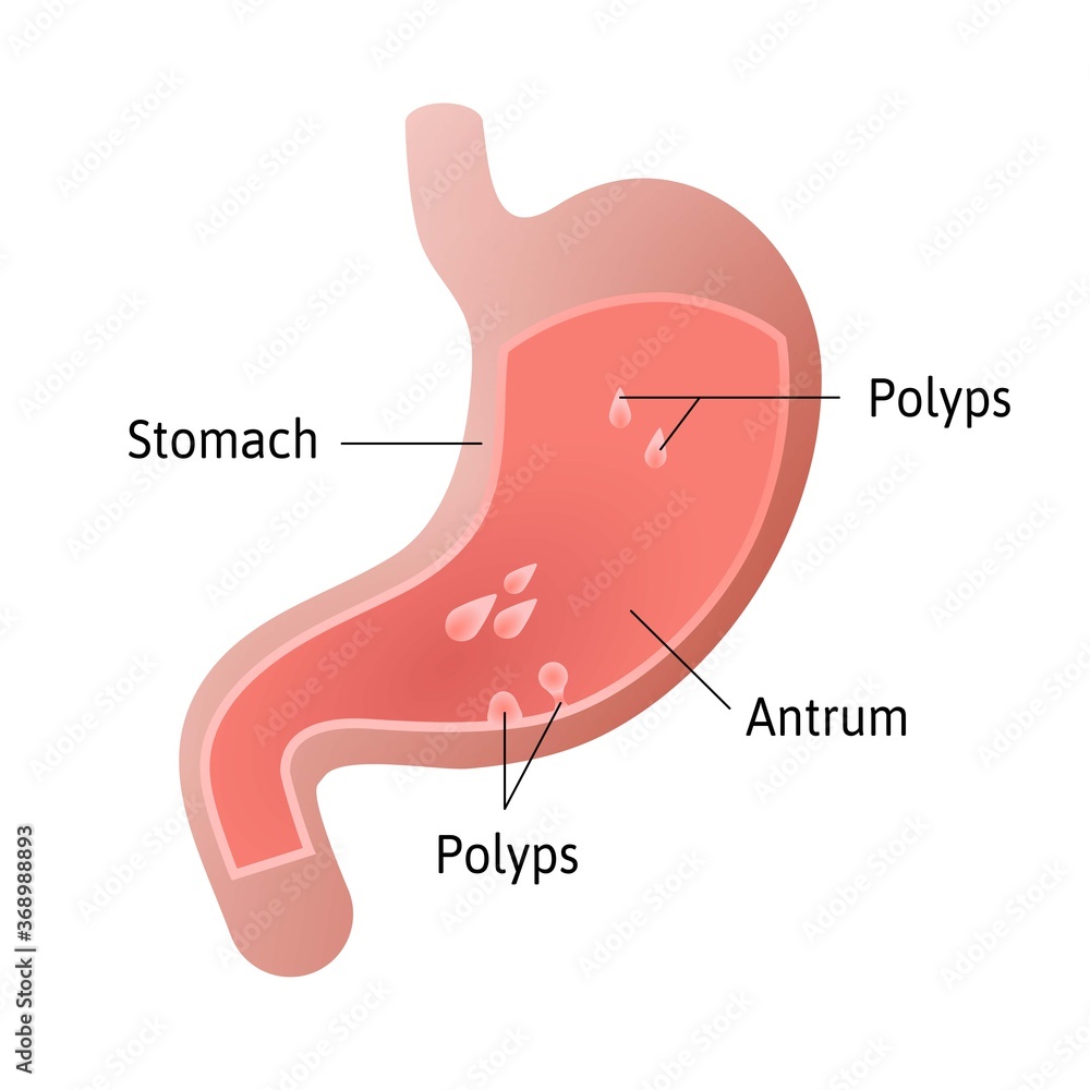 gastric polyps, masses of cells that form on the lining inside stomach ...