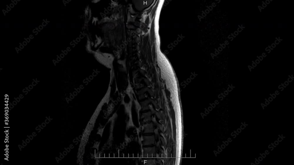 monochrome MRI spine scan, magnetic resonance imaging of a back and ...