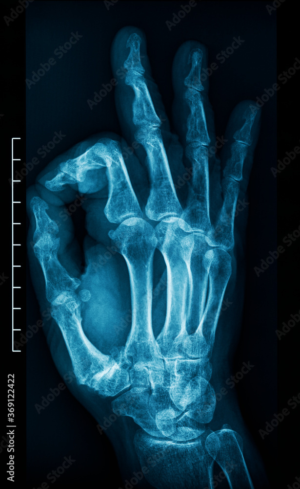 X-ray of an human hand doing the OK sign with the fingers Stock Photo ...