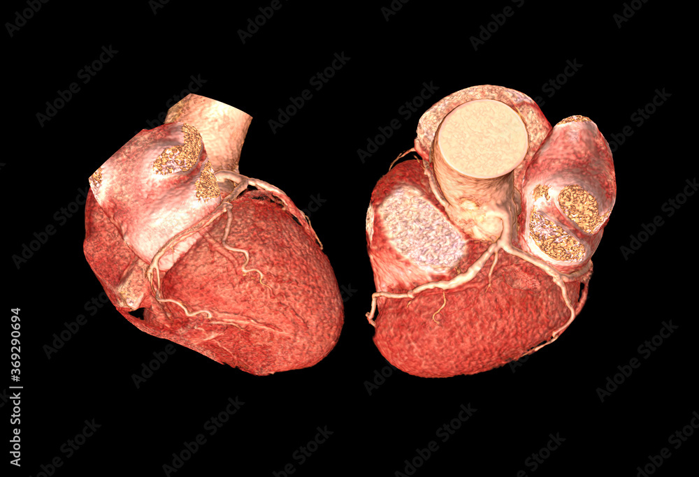 Lateral ad Top view of CTA Coronary artery 3D rendering image isolated ...