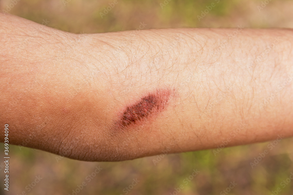 Closeup wound at elbow background. Child get fresh wound at arm skin by ...