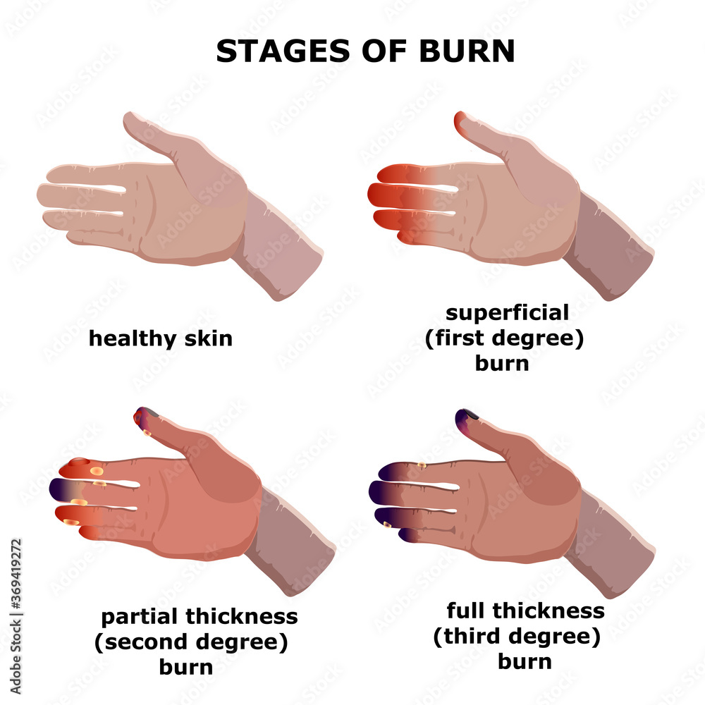 Medical vector illustration. Burn stages. Degree burns of skin. Stock ... Medical vector illustration. Burn stages. Degree burns of skin. Stock ...