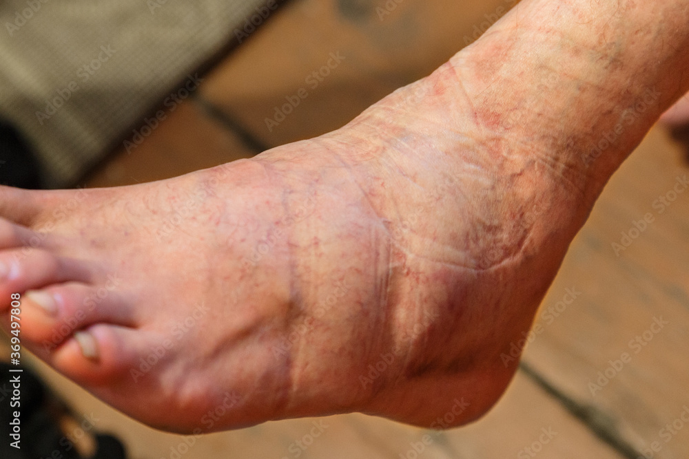 Foto de A close-up of a man's injured foot swollen from a sprained ...