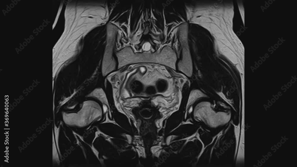 MRI of the female pelvic organs, abdominal cavity, gastrointestinal ...