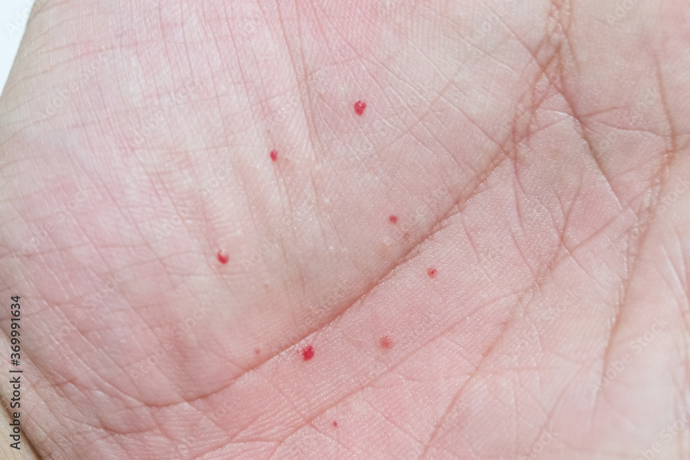 Atopic dermatitis (AD) on the hand, also known as atopic eczema or ...