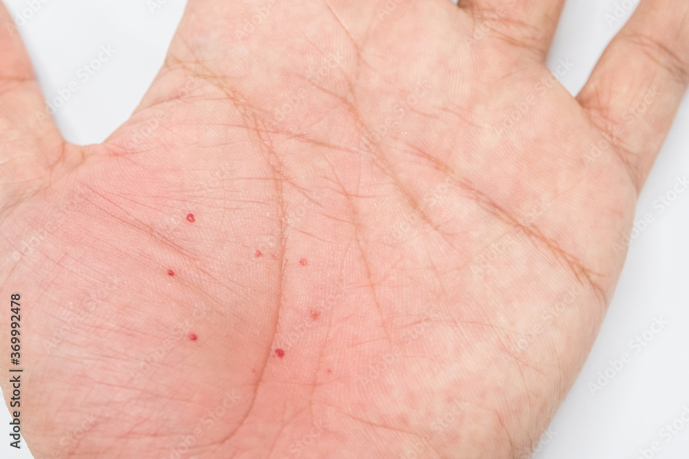 Foto de Atopic dermatitis (AD) on the hand, also known as atopic eczema ...