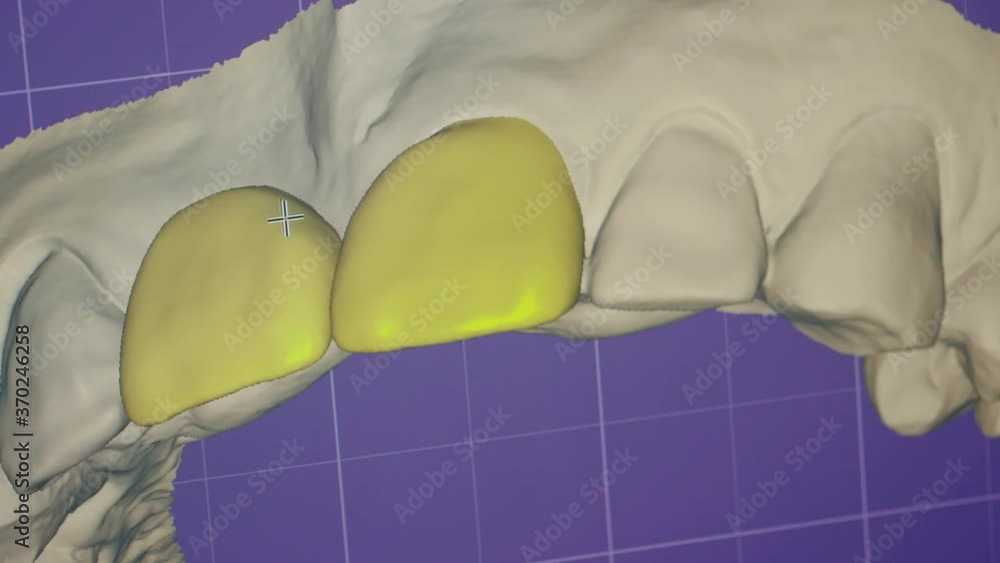 Screen with 3D modeling teeth showing on computer dental implant ...