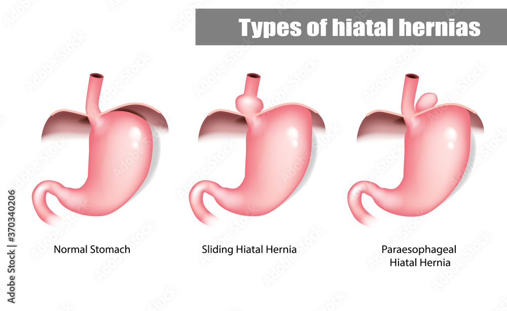 Types of hiatal hernias sliding and paraesophageal. Stock Vector ...