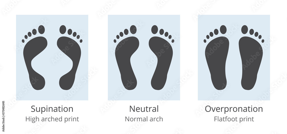 Foot arch variation diagram - supination and overpronation and normally ...