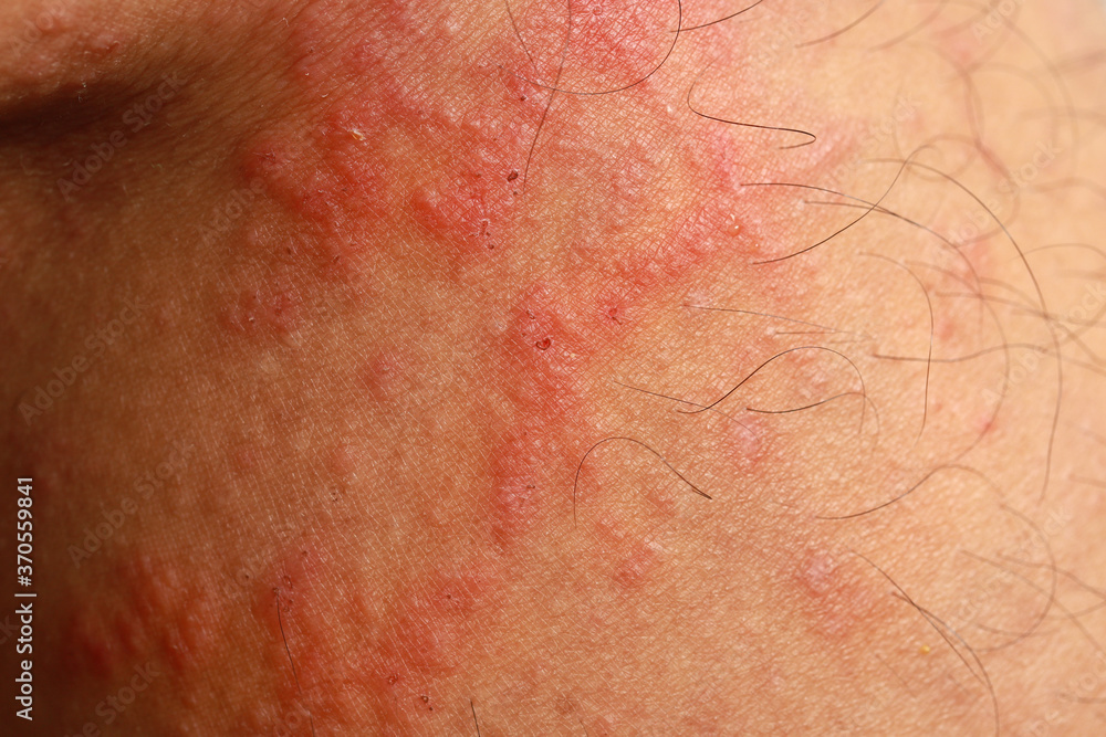 Close up dermatitis on skin, ill allergic rash dermatitis eczema skin ...
