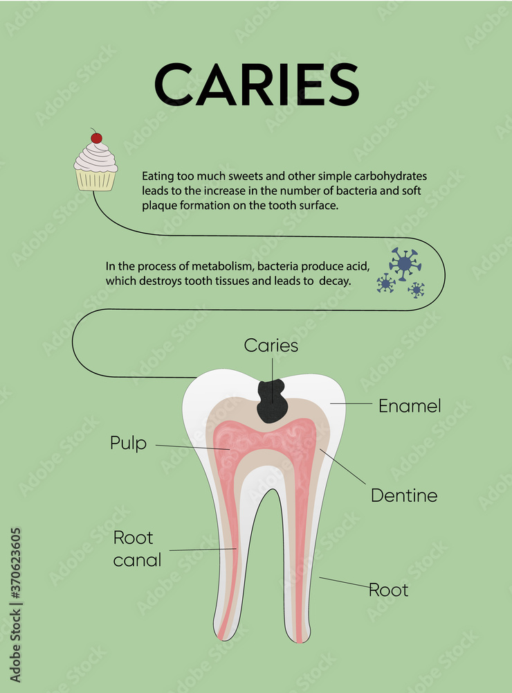 Patient education poster showing the process of caries formation in the ...