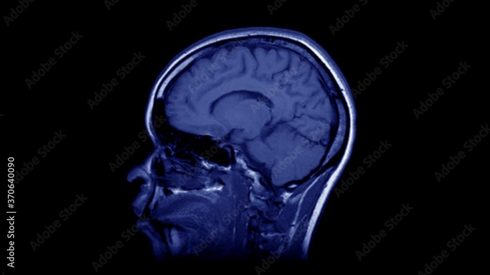 Time lapse of MRI brain scan, timelapse of blue magnetic resonance ...