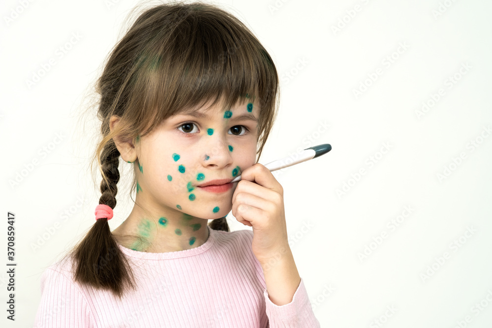 Child girl covered with green rashes on face ill with chickenpox ...