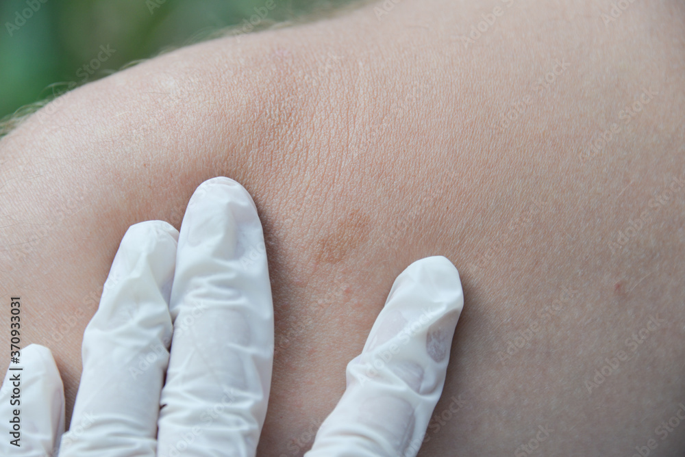 Skin diseases irritation, itching, cracked wounds lead to painful ...