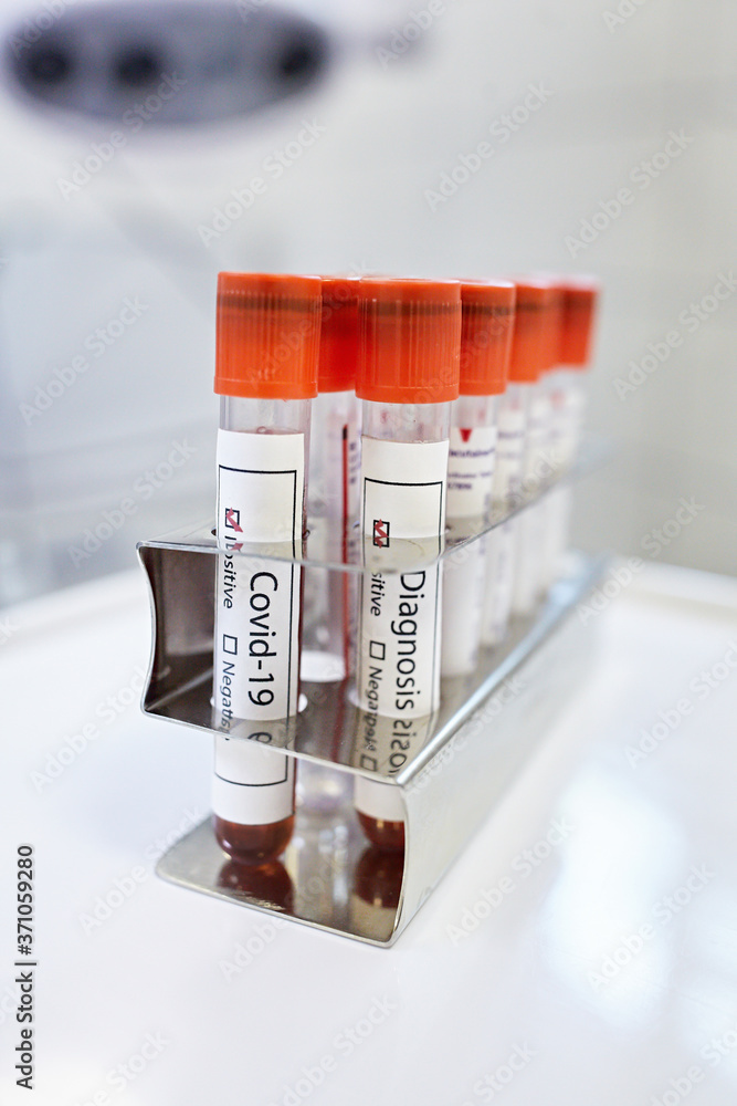 A tubes with test blood covid-19. Covid-19 diagnostic in clinic.T est ...