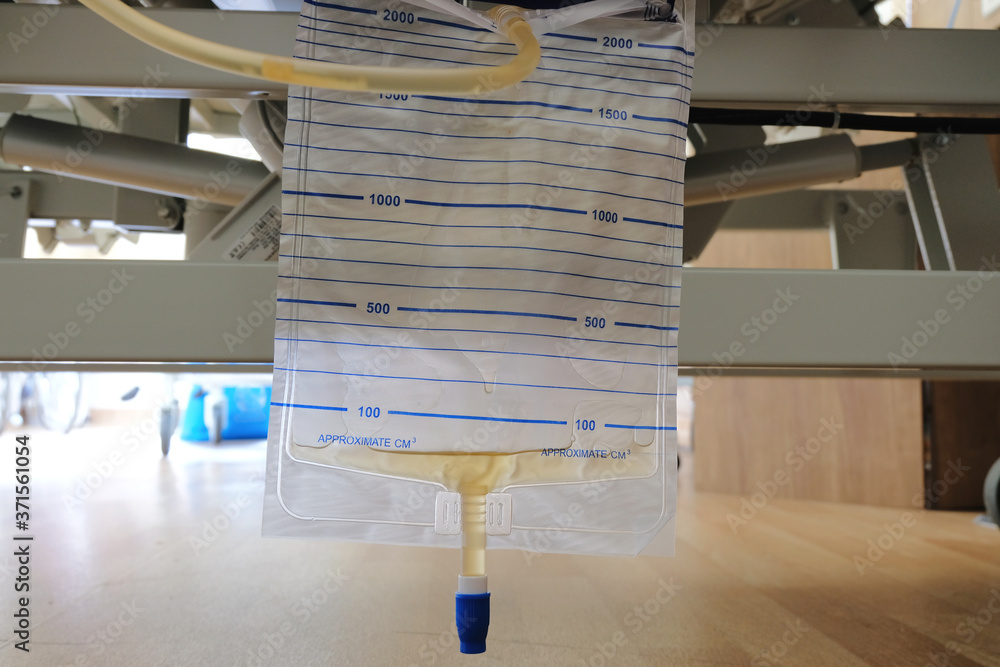 Urinary bag hanging by the side of a hospital bed as urine is drained ...