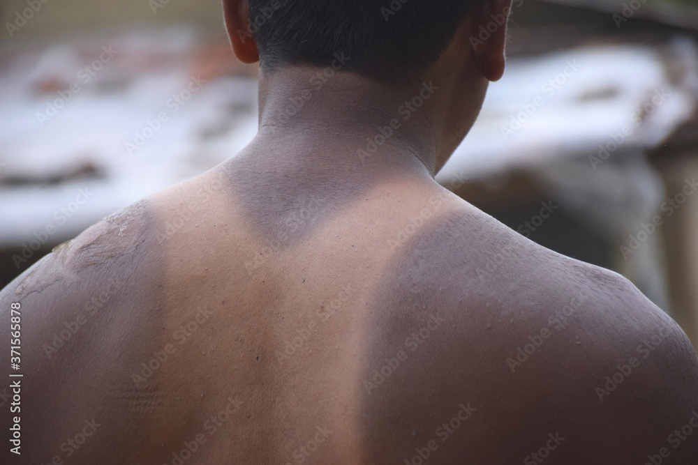 Extra sun-scorched shoulders and neck skin, The body part between the ...