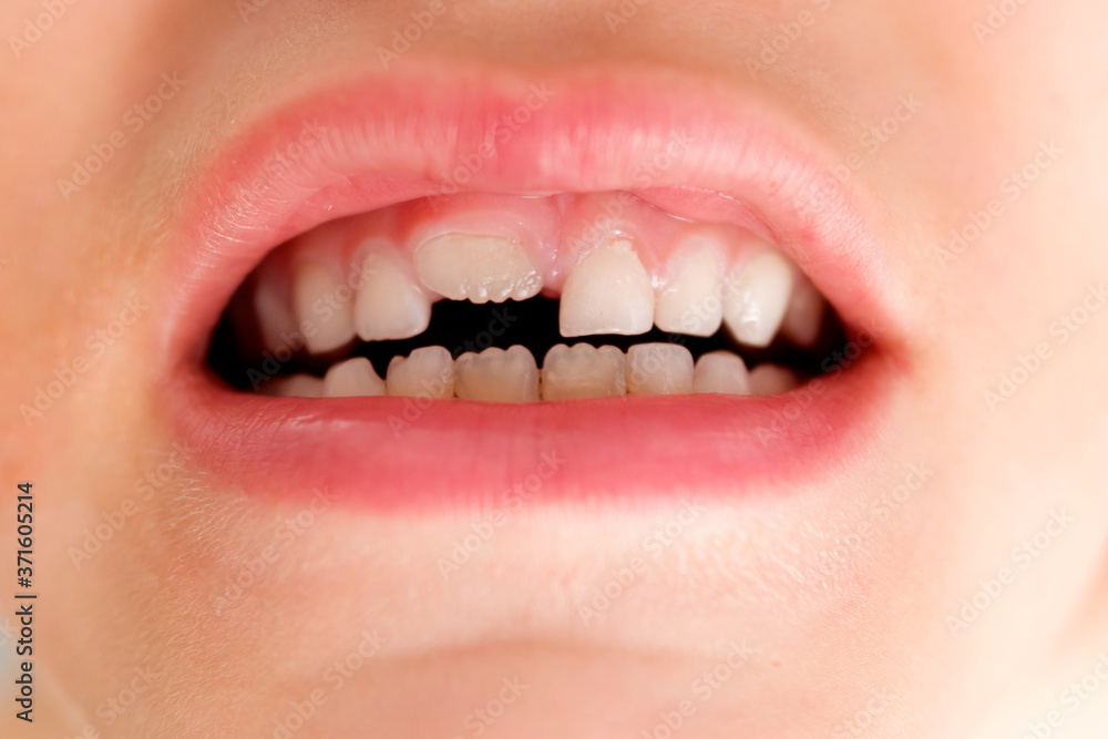 Fotografia do Stock: A child with an open mouth shows his new tooth, an ...