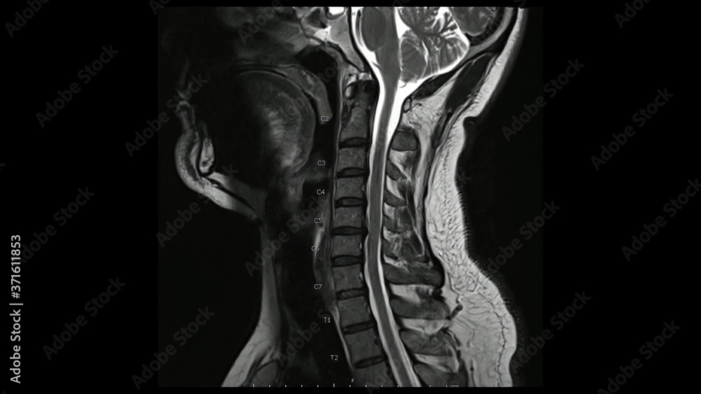 Magnetic Resonance images of Cervical spine sagittal T2-weighted images ...