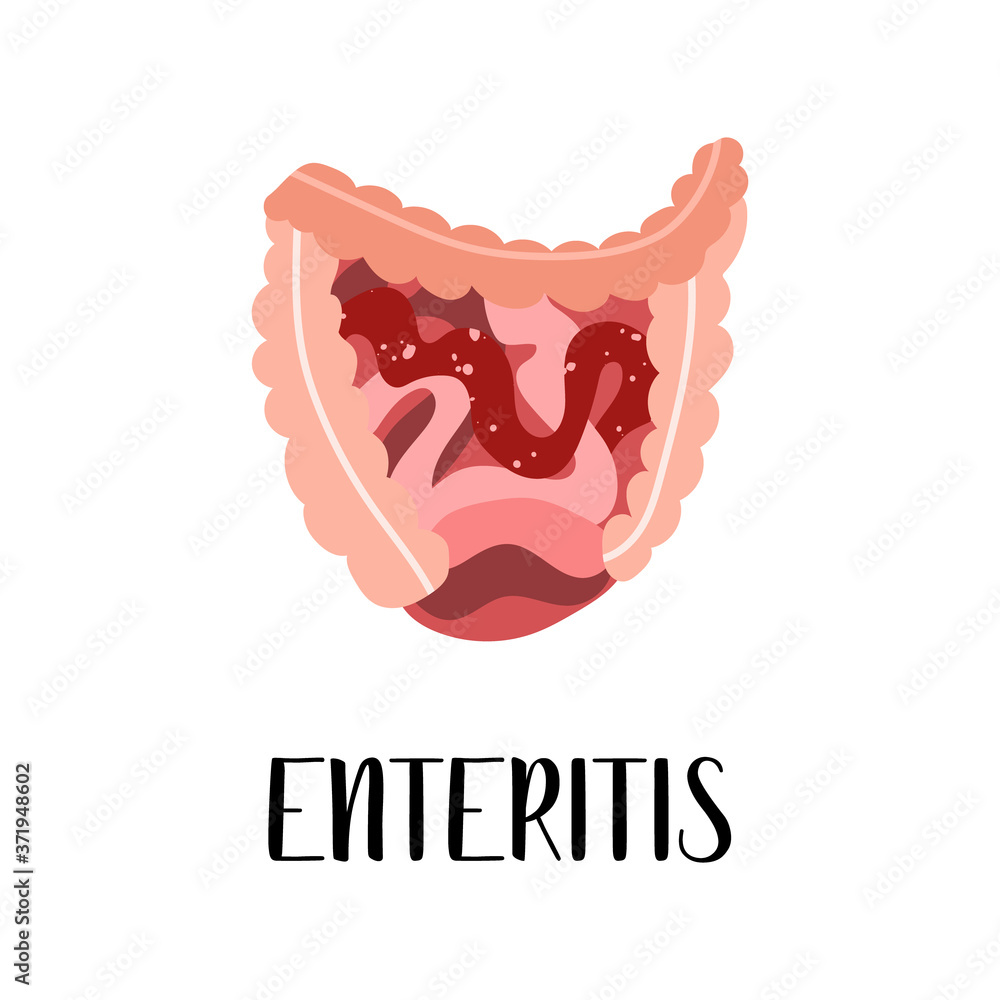 Enteritis, inflammation of the small intestine. Gut diseases ...