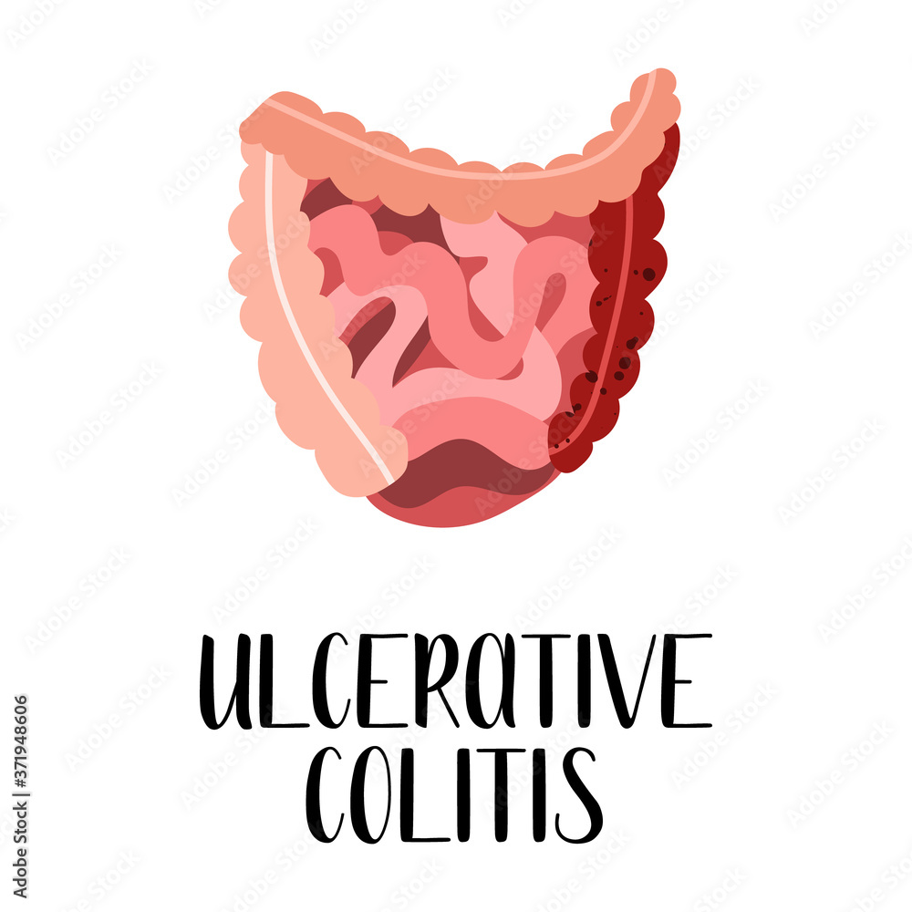 Ulcerative colitis. Intestines diseases. Gastroenterology. Vector flat ...