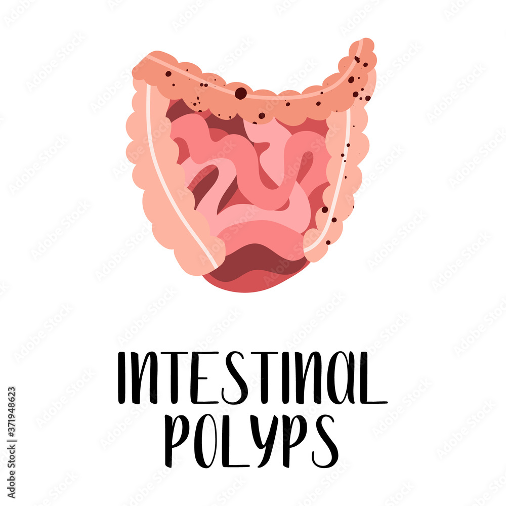 Intestinal polyps. Intestines diseases. Gastroenterology. Vector flat ...