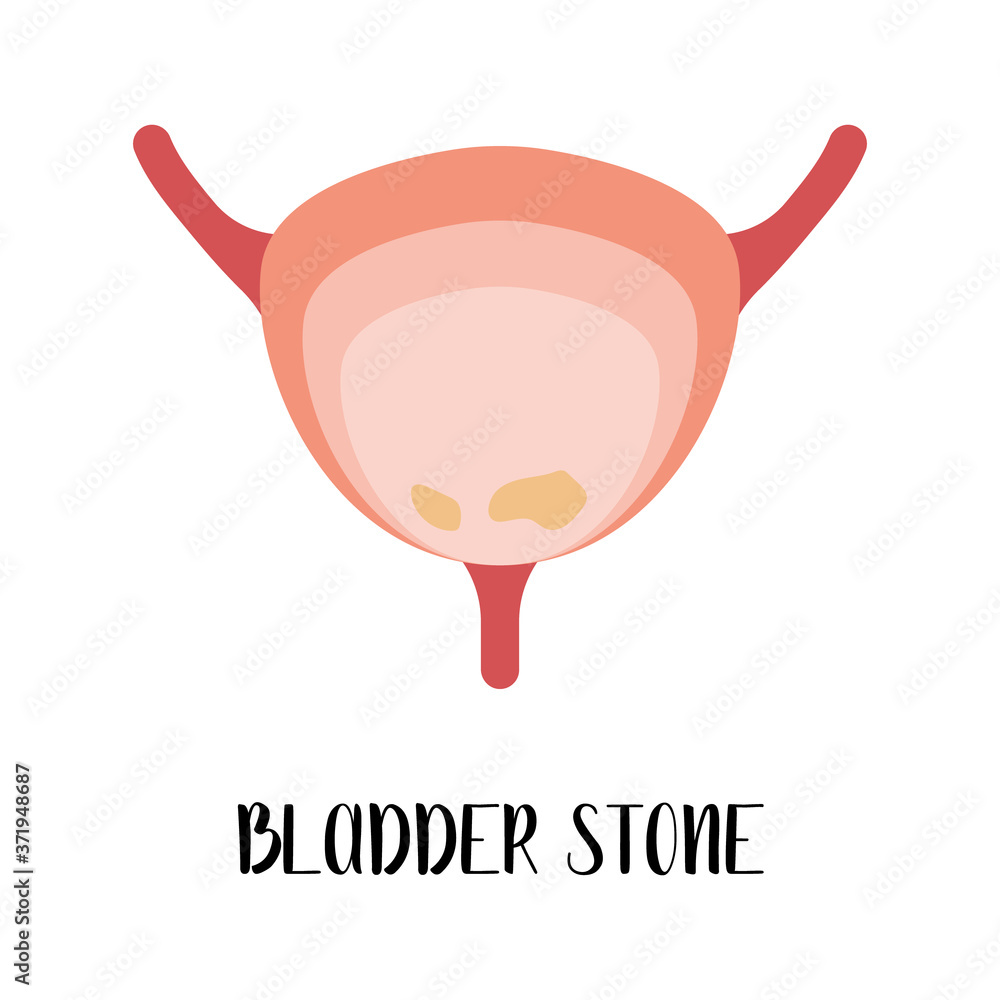 Vetor de Bladder stones. Bladder disease. Urology. Vector flat ...