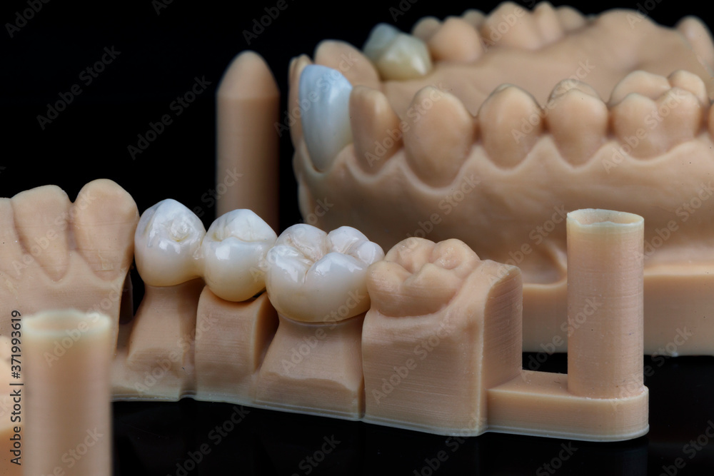 milled dental crowns made of dental zircon on resin models Stock Photo ...