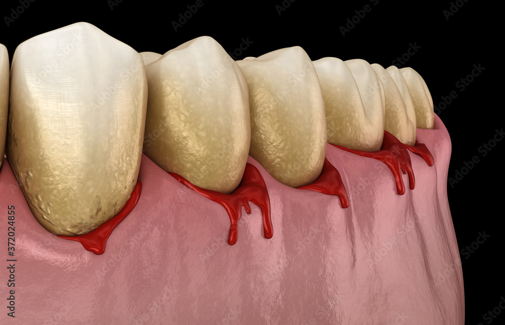 Bleeding gums or Periodontal - pathological inflammatory condition of ...