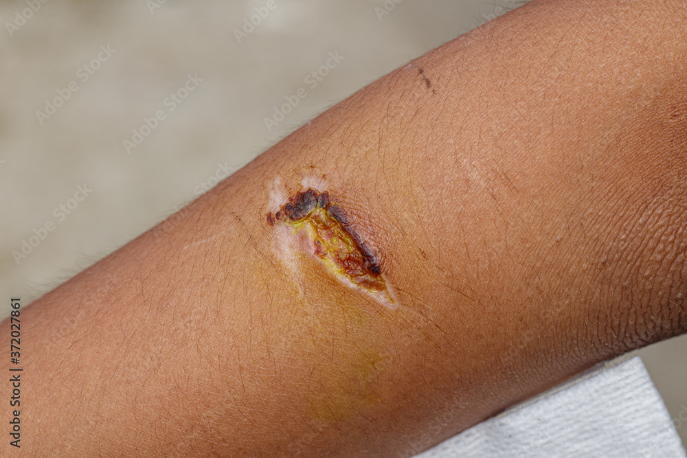 Foto de Lesion on arm skin begin scab dried on the epidermis. do Stock ...