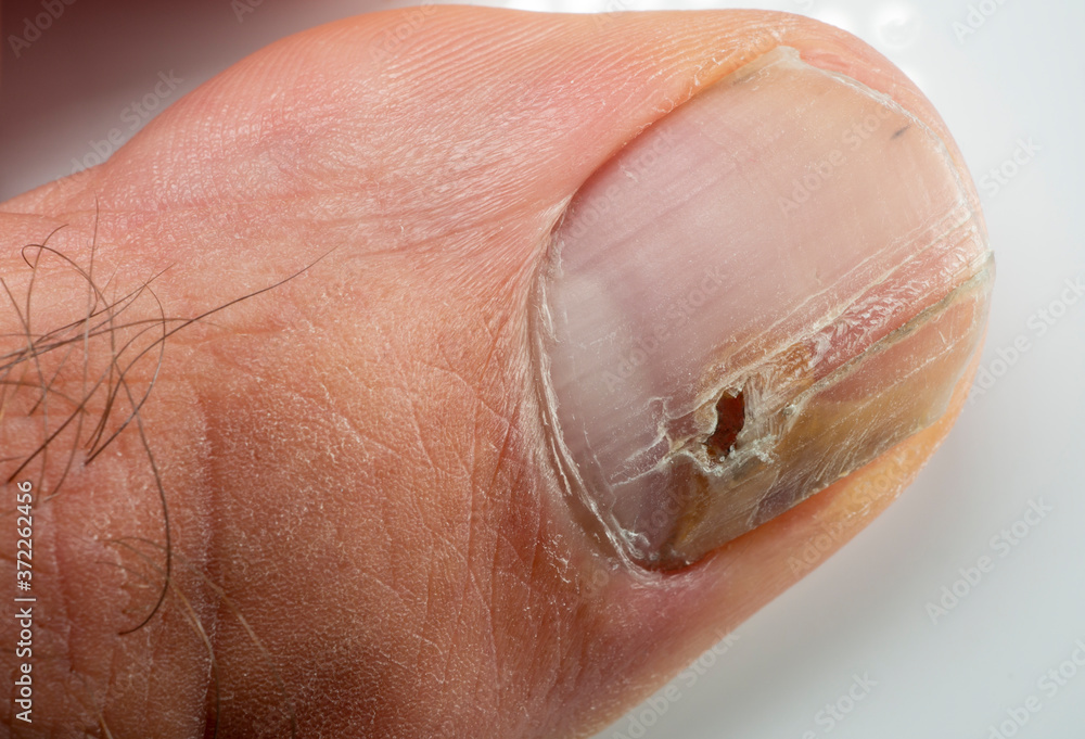 Nail infections caused by fungi such as: onychomycosis also known as ...