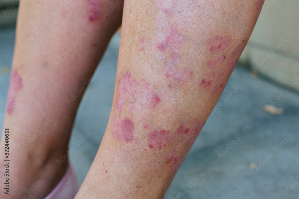 Psoriasis On Legs