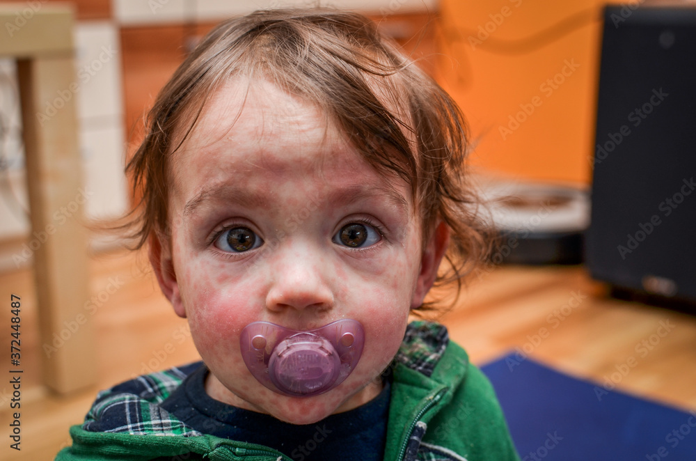 Foto de Children viral disease or allergies. Red measles rash on baby ...