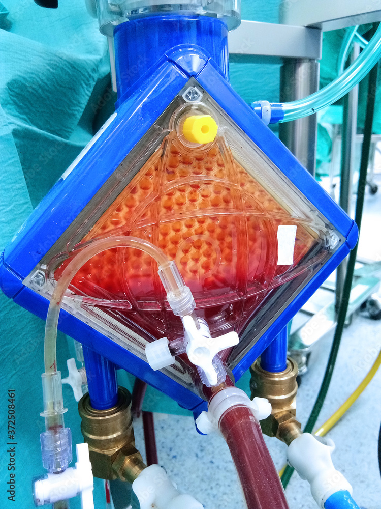 Oxygenator after off Extracorporeal membrane oxygenation (ECMO) from ...