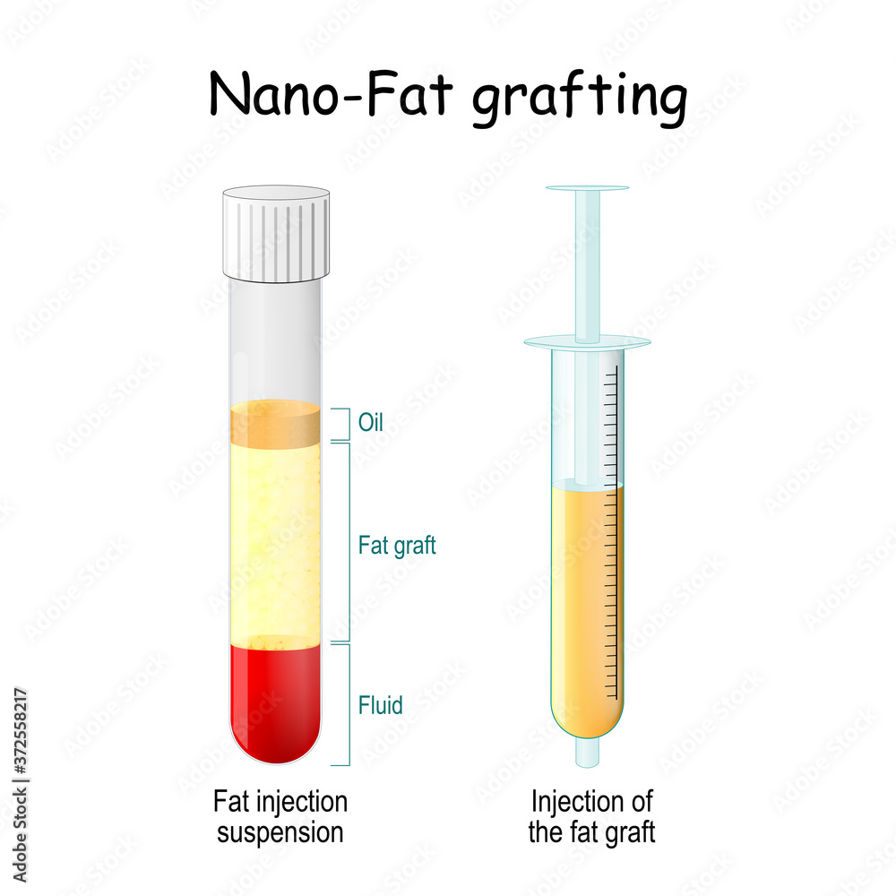 Nano-Fat grafting. test tube with Fat injection suspension. syringe ...