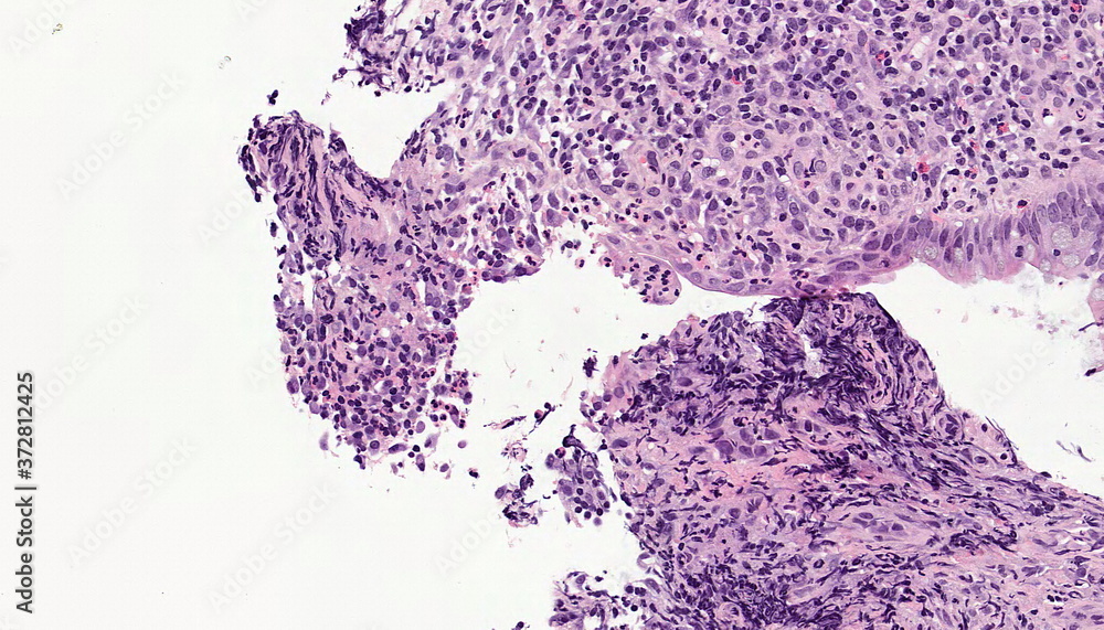 Erosion of the colon - microscopic image 20x Stock Photo | Adobe Stock