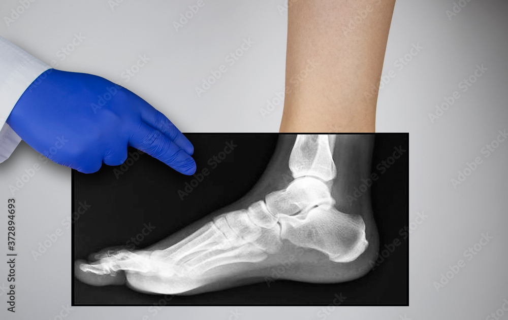 X-ray of a woman's foot. A photograph of the leg bones is applied to ...