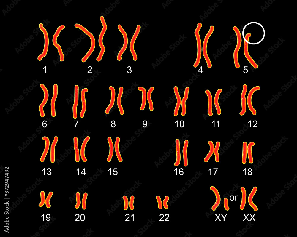 Karyotype of Cri du chat, or cat's cry, syndrome, also known as 5p ...