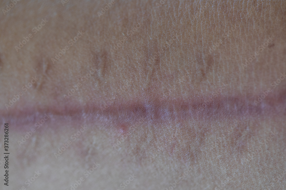 A scar is an area of fibrous tissue that replaces normal skin after an ...