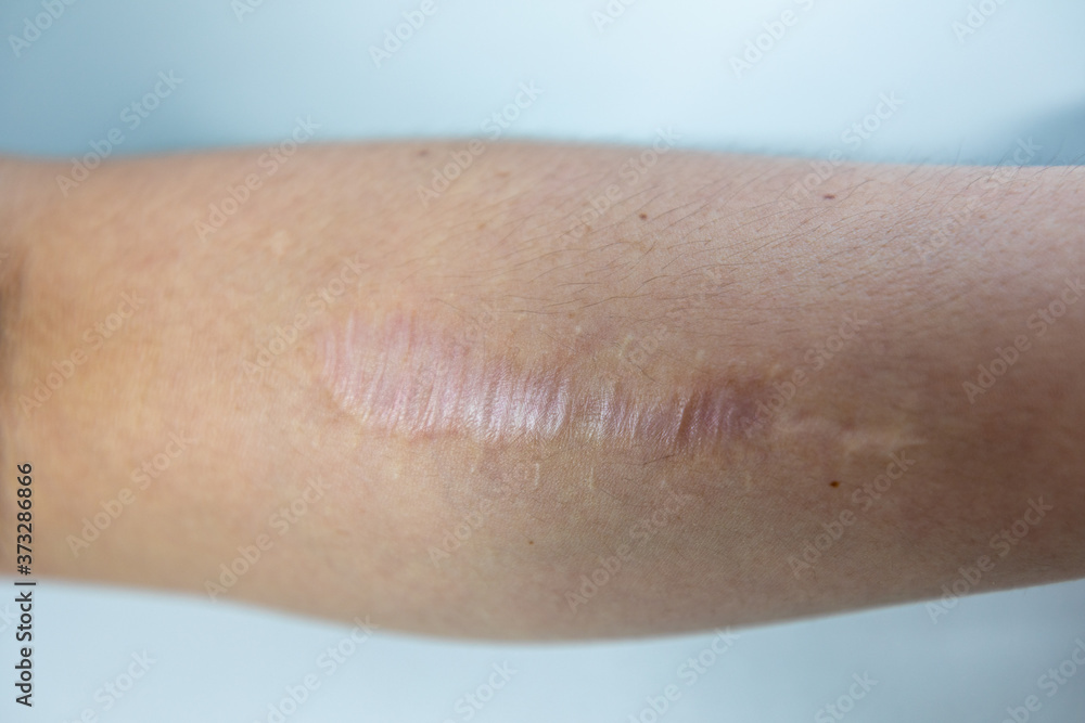 A scar is an area of fibrous tissue that replaces normal skin after an ...