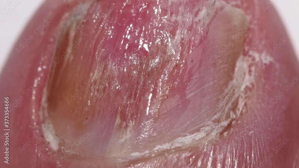 Macro photography of Big toenail with Onychomycosis, a fungal infection ...