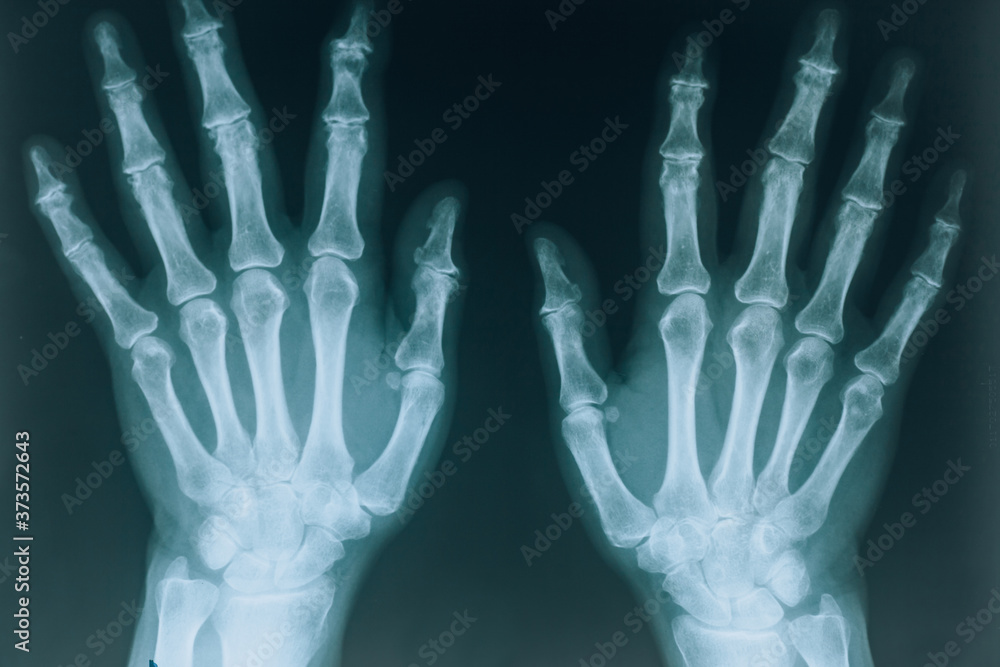 X-ray of hands. Two hands, X-ray close-up, front projection Stock Photo ...