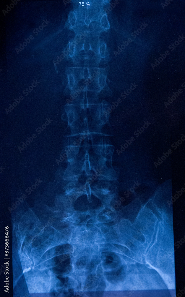 X ray of Vertebrae - Spinal column. Stock Photo | Adobe Stock