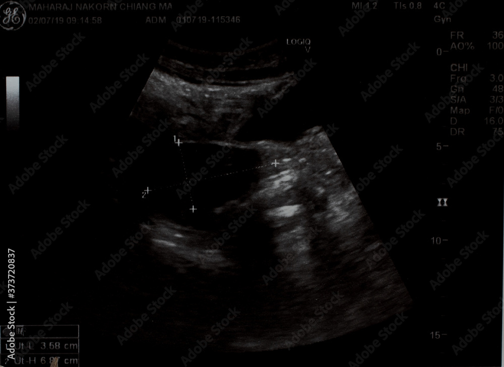 Film Ultrasound, ovarian cysts,Internal organs examination for women ...