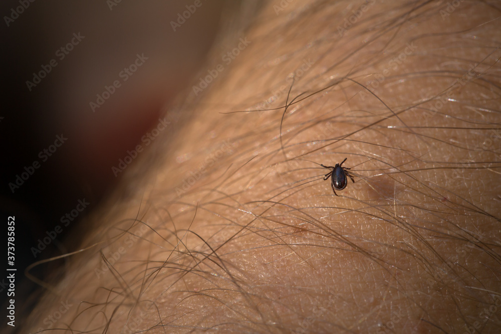 Tick Acari mite on human skin. Dangerous insects. Stock Photo | Adobe Stock
