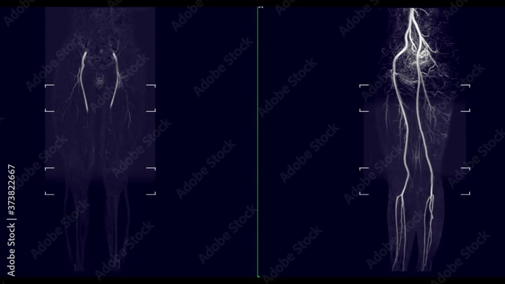 Compare of Magnetic resonance angiography or MRA of the aorta, iliac ...