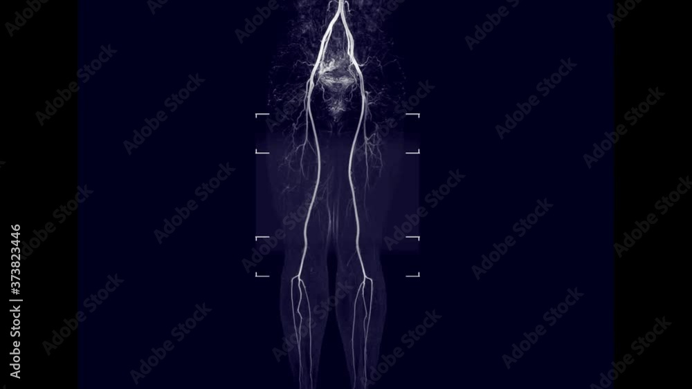 Magnetic resonance angiography or MRA of the aorta, iliac, and femoral ...