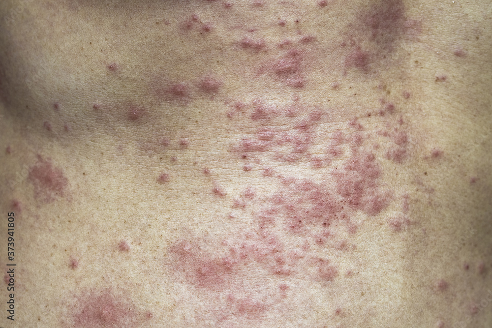 Itchy rash, Skin rash on body, Stock Photo | Adobe Stock